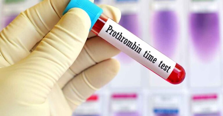 Prothrombin Time – DoctorOnHealth