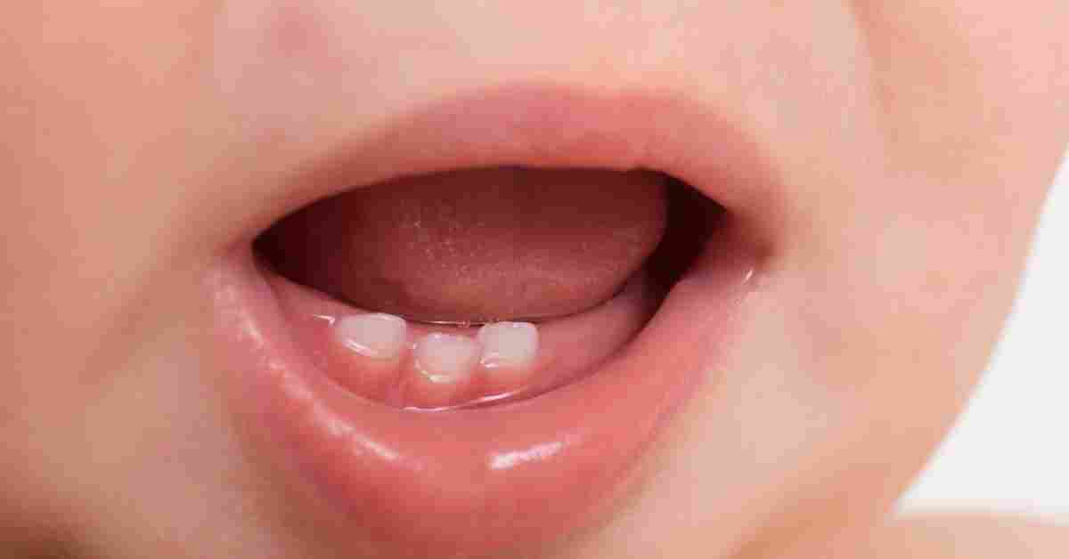 Teeth Eruption Chart – DoctorOnHealth